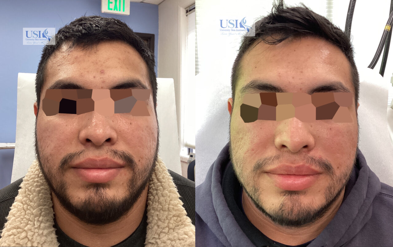 Acne Scar Treatment - University Skin Institute