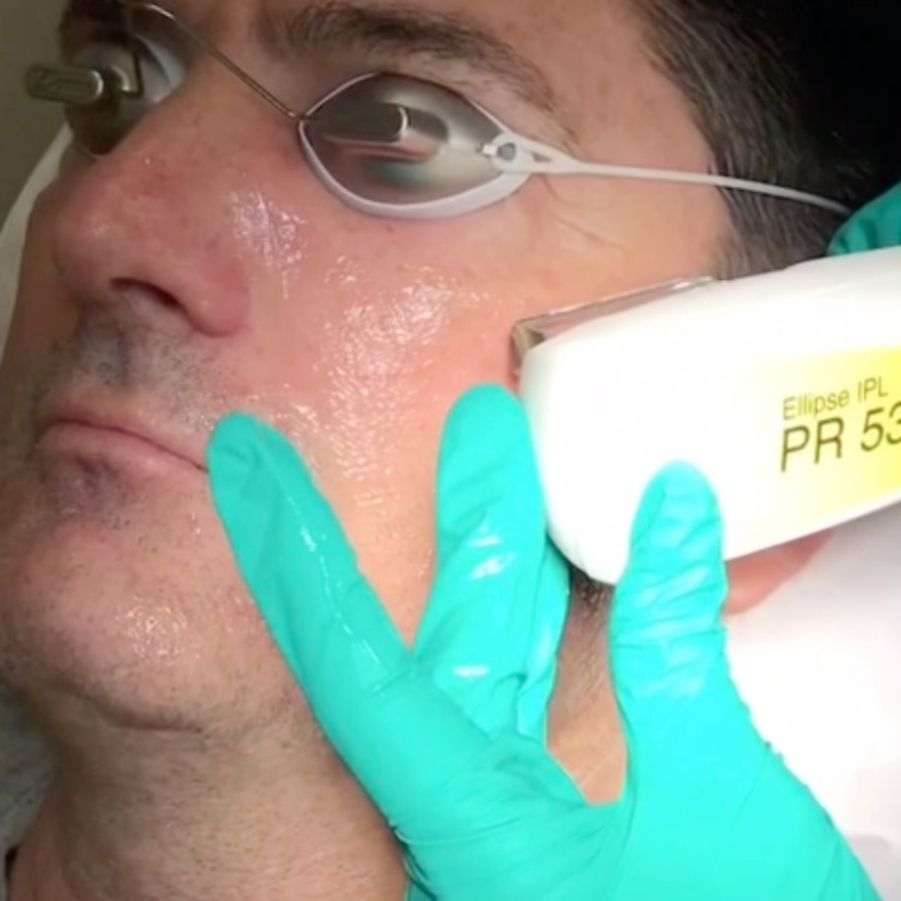 IPL Treatments Intense Pulsed Light (IPL) treatment is often referred ...