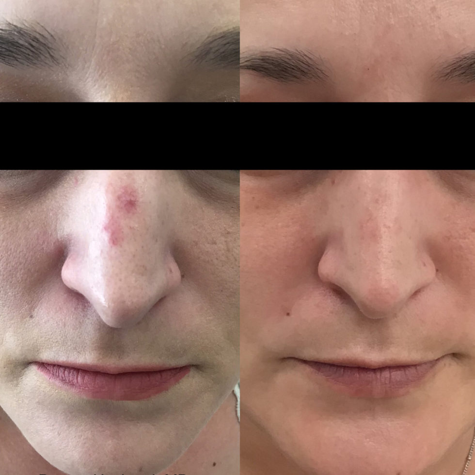 IPL Treatments Intense Pulsed Light (IPL) treatment is often referred ...